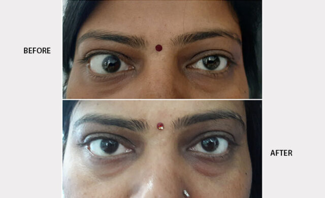 Oculoplasty And Ocular Aesthetics Treatment Dr Anisha Gupta