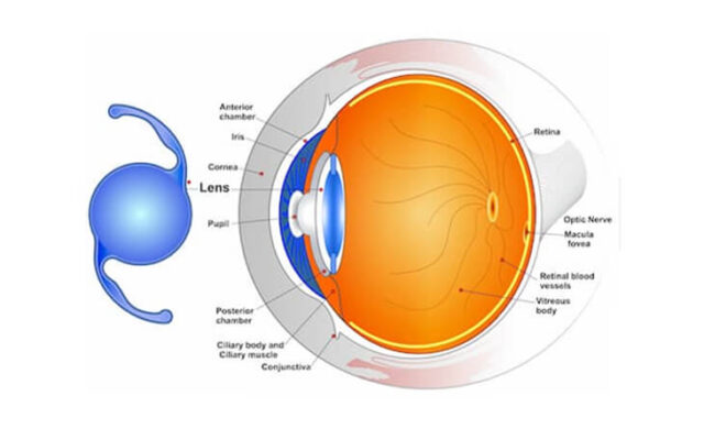 Types of intraocular lens for cataract surgery | Dr Anisha Gupta