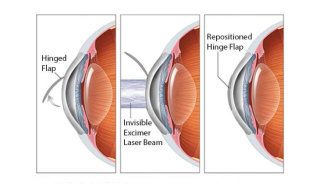 Lasik Surgery in Delhi | Eye Specialist - Dr Anisha Gupta