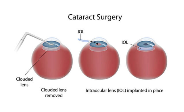 How Do I Choose The Best Cataract Surgery Hospital ? Excel Eye