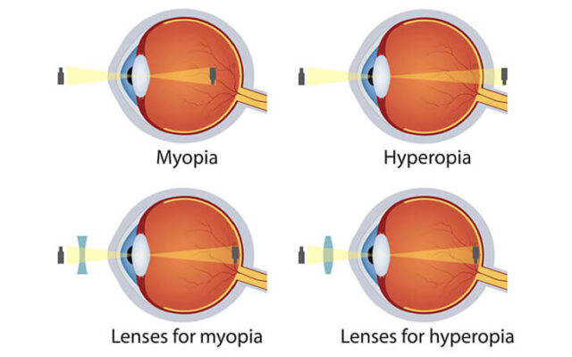 Types of Refractive Errors And How They Are Corrected | Dr Anisha