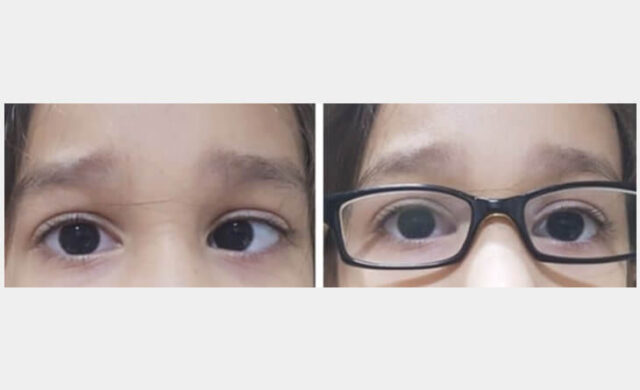 Can Squint be Treated with Eyedrops or Exercises? Dr Anisha