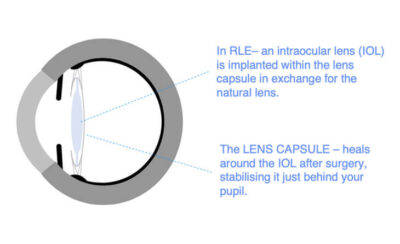 What is Refractive or Lasik Surgery?