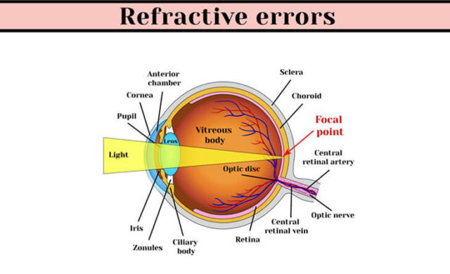 What Are the Different Types of Refractive Errors & Their Correction