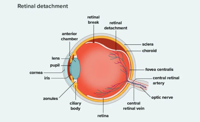 What is the Most Common Cause of Retinal Detachment?
