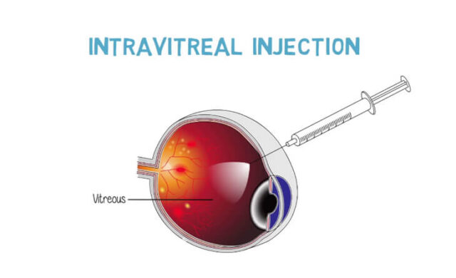 Intravitreal Injections for Diabetic Retinopathy - Dr Anisha Gupta