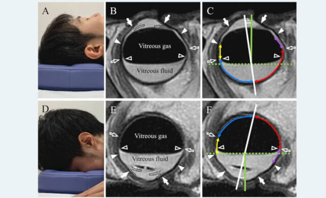 Everything You Need to Know About Retinal Detachment
