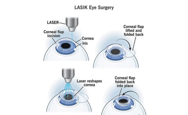 How long does LASIK last? Dr Anisha Gupta - Eye Specialist Delhi