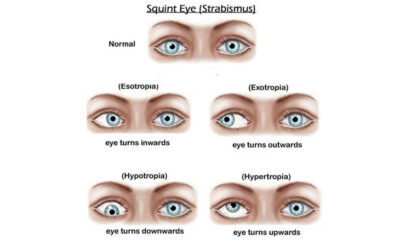 Squint Eye Surgery: Types, Causes, Treatment and Cost
