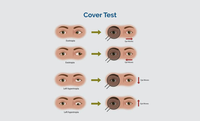 Squint Eye Surgery: Types, Causes, Treatment and Cost