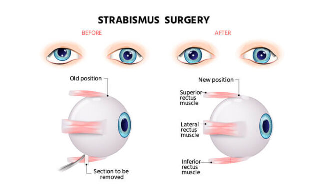 Squint Eye Surgery: Types, Causes, Treatment and Cost