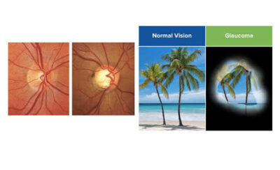 Glaucoma: Types, Symptoms & Treatment