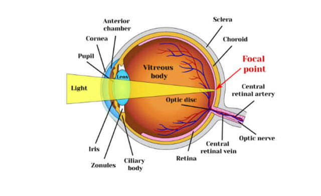 Refractive Errors: Types, Signs, Causes, and Treatment
