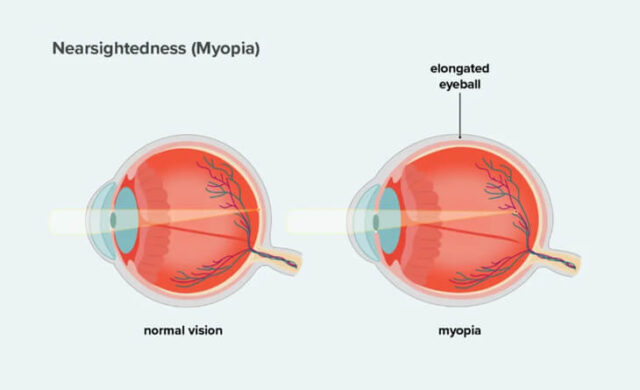 Refractive Errors: Types, Signs, Causes, and Treatment