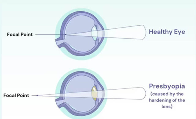 Refractive Errors: Types, Signs, Causes, and Treatment