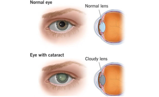 What is the Standard Lens Used for Cataract Surgery?