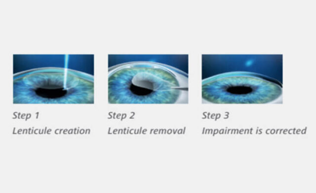 Eye Operation for Removing Spectacles