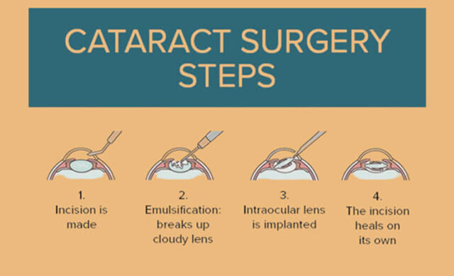 How Long Does Cataract Surgery Last?