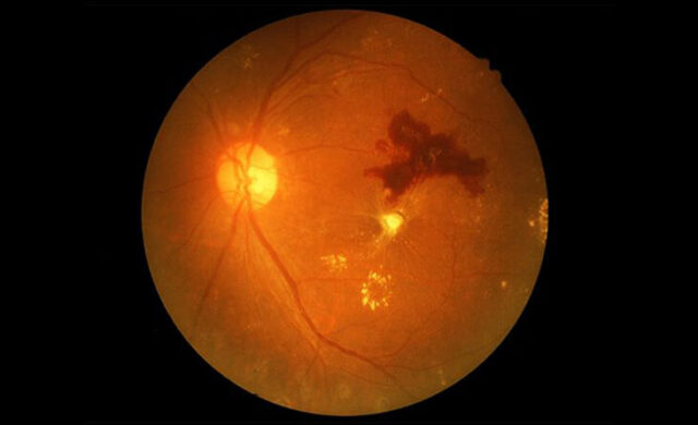 Retinal Hemorrhage – Symptoms, Causes and Treatment - Excel Eye Care